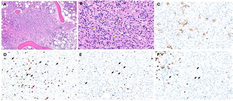 Frontiers Case Report Pitfalls In Bone Marrow Evaluation Importance