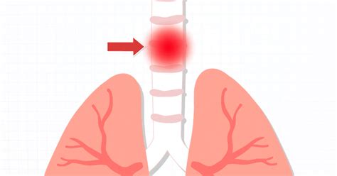 Tracheal Disorders Types Symptoms And Treatment 2025