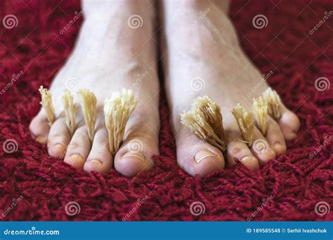 White Fungus On Skin
