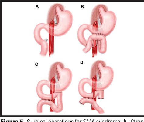 Figure 5 From Superior Mesenteric Artery Syndrome Semantic Scholar