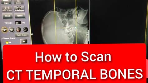 What Is A Bone Ct Scan At Victor Easley Blog