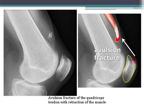Types Of Bone Fracture Amal Jameel Hamzah Alajarma