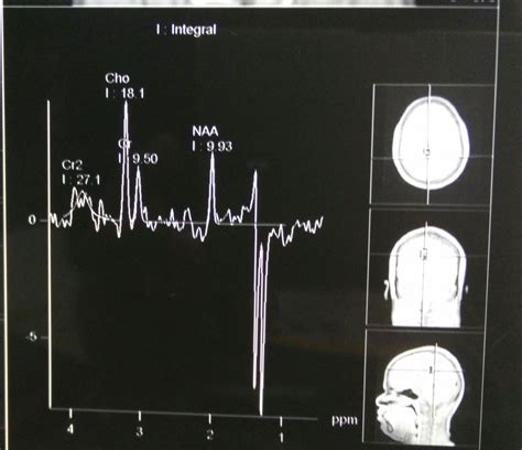 Tumefactive Demyelinating Lesion Pacs