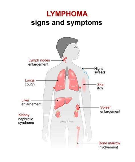Types Of Lymphoma Symptoms And Risk Factors