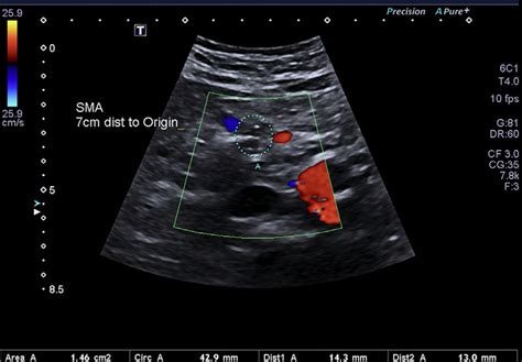Duplex Scan Of The Mesenteric Vessel Demonstrating A Normal Flow In