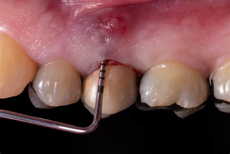 Management Of A Post Extraction Dehiscence Defect Utilizing A Minimally