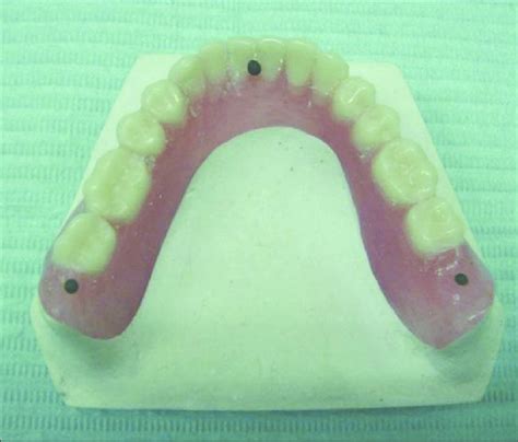 Conventional Mandibular Denture At Natalie Hawes Blog