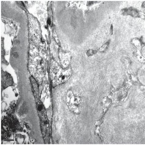 Renal Pathological Features Of Electron Microscopy A Massive