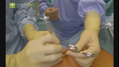 Transabdominal Preperitoneal Patch Tapp Repair Of Inguinal Hernia 2 Trocar Positions Youtube