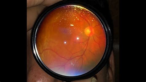 Buckle Vitrectomy With Peripheral Retinotomy For Retinal Shortening Pvr