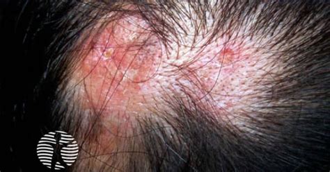Discoid Lupus Erythematosus Image
