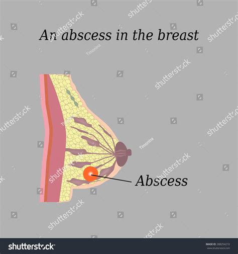 Abscess Chest On Gray Background Structure Stock Vector Royalty Free 288254210 Shutterstock