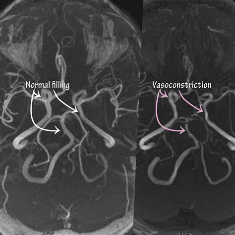 Overview • Reversible Cerebral Vasoconstriction Syndrome Rcvs Aka