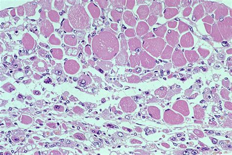 Cytoplasmic Vacuolation