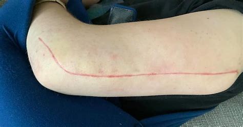 Arm Operation Album On Imgur