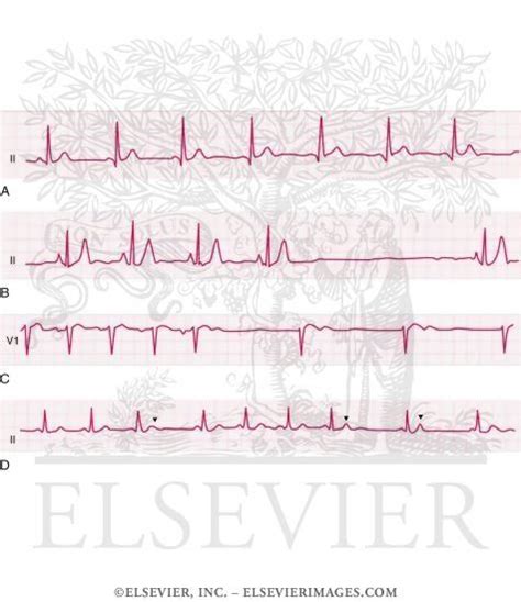 Best Images About Cardiac Images On Pinterest Qrs Complex Activities And Distance