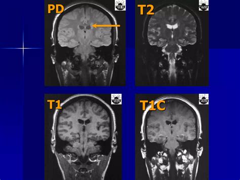 Neuronal Migration Disorders Pdf