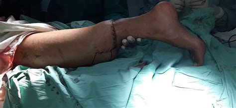 Removal Of Spindle Cell Tumor Of The Tibia Rmedicalgore