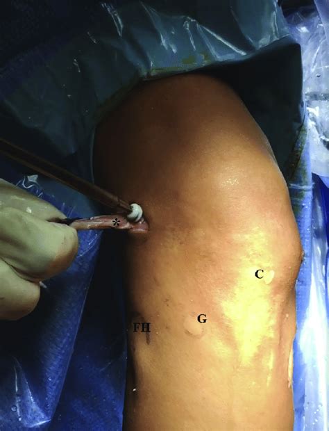 Insertion Of The Interference Screw For Femoral Fixation Right Knee Download Scientific