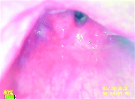 Patient With A Cormack Lehane 2 Grade Visualized By Vl3