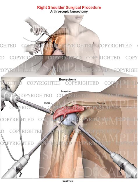 Right Shoulder Arthroscopic Repair Bursectomy Female Medical Art