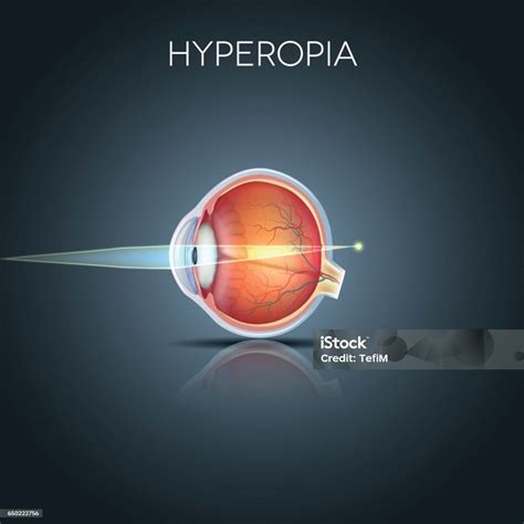 Hyperopia Stock Illustration Download Image Now Anatomy Art Care Istock