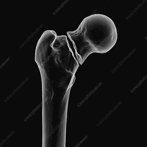 Transcervical Femur Fracture Illustration Stock Image F0439263