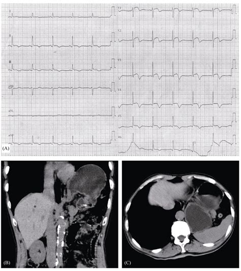 Emergency Ecg At The Time Of Onset A Computed Tomographic Axial