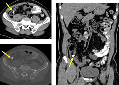 Appendicolith Radiology Cases