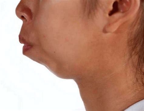 Transformación De Una Chica Con Mandíbula Malformada