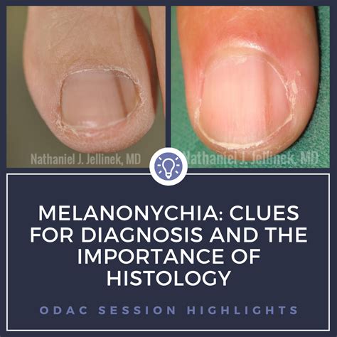 Melanoma Nail Symptoms