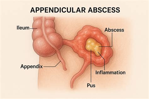 Comprehensive Overview Of Appendicular Abscess Diagnosis And Treatment Medagg