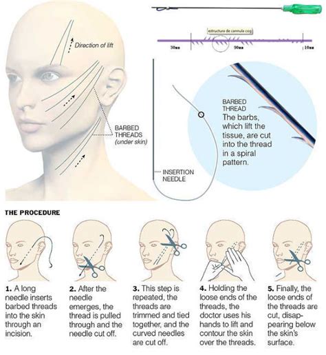 Buy Wholesale China Double Needle 20g290mm Smooth Pdo Threading For Jowls Neck Lift Cost