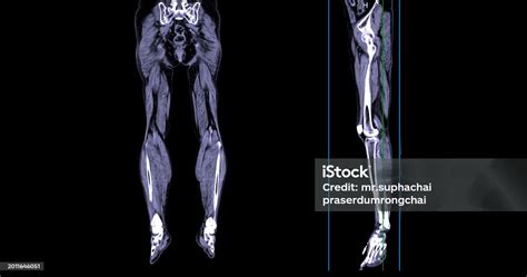 A Ct Venogram Of The Leg Is A Noninvasive Imaging Procedure Offering Detailed Visuals Of Leg