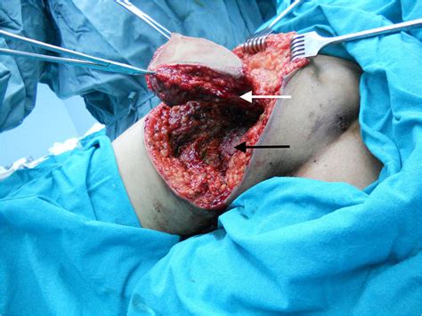 Flap Elevated With Muscle Carrier White Arrow Indicates Gluteus