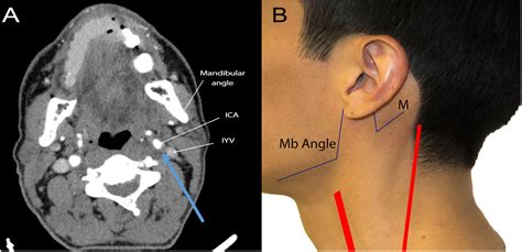 Posterior Cervical Triangle Approach For Carotid Endarterectomy