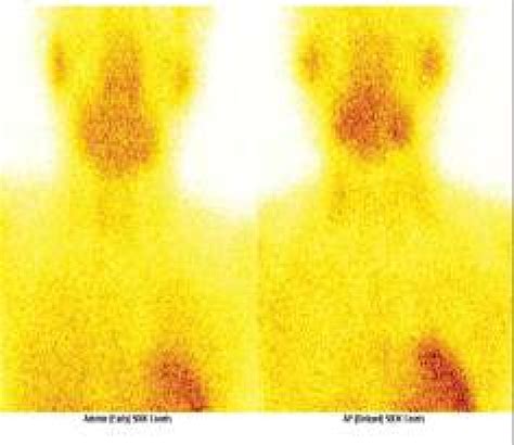 Early Static Image Of 99mtc Sestamibi Scan Showing Normal Sized Thyroid