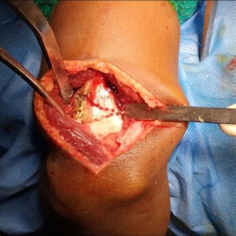 Intraoperative Image Showing Osteotomy Lines Marked With Electrocautery Download Scientific