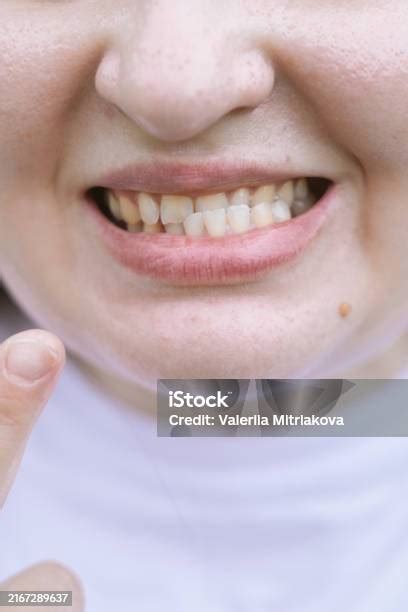 Patient With Dislocated Jaw And Malocclusion Temporomandibular Joint