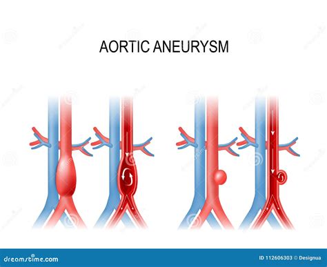 Aneurysm Vector Illustration Labeled Medical Outward Bulging Vessel
