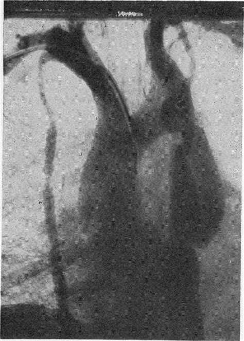 Arch Aortogram Anteroposterior View Download Scientific Diagram