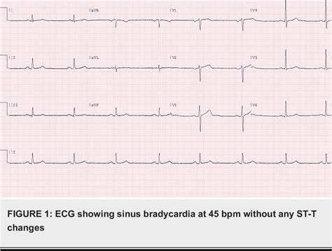Figure 1 From Recurrent Myocarditis Following Covid 19 Infection And