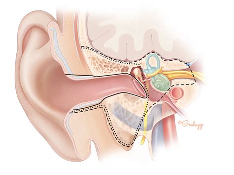 Lateral Temporal Bone Resection Oto Surgery Atlas