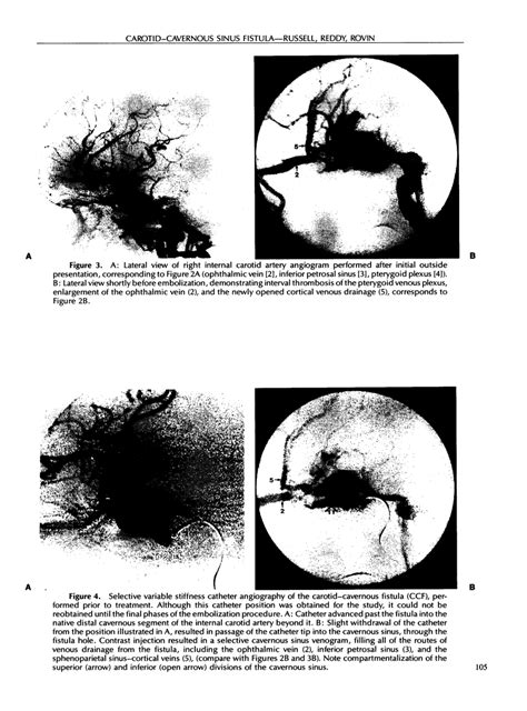 Combined Arterial And Venous Approaches For Cure Of Carotid Cavernous