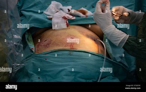 Laparoscopic Surgery Requires Stitches After Surgery After The Surgery The Doctor Finishes The