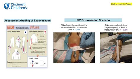 Ppt The Development And Implementation Of A Venous Extravasation