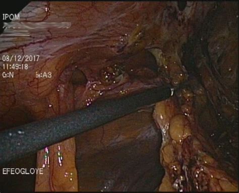 Ipom Hernia Repair Dr Efeoglou Anastasios