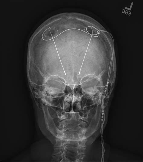 Twiddlers Syndrome In Deep Brain Stimulation Pmc