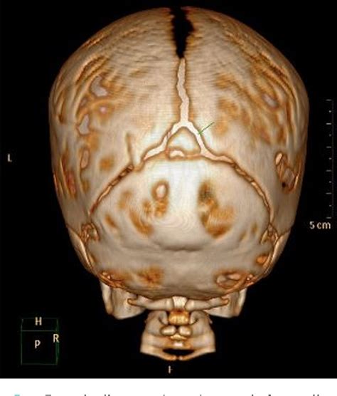 Figure 5 From Les Os Wormiens Dans Une Population Pédiatrique Générale