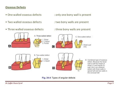 024bone Loss And Patterns Of Bone Destruction